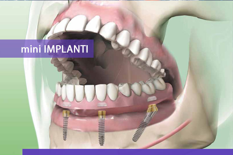 Mini implanti - Stomatološka ordinacija Beogradski Osmeh