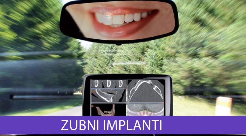 Zubni implanti - Cene, vrste, procedura, protetika, besplatne konsultacije